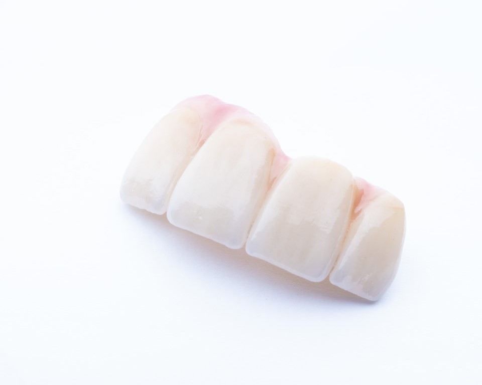 Corone e Ponti Dentali per un Sorriso Naturale - Orto Nova